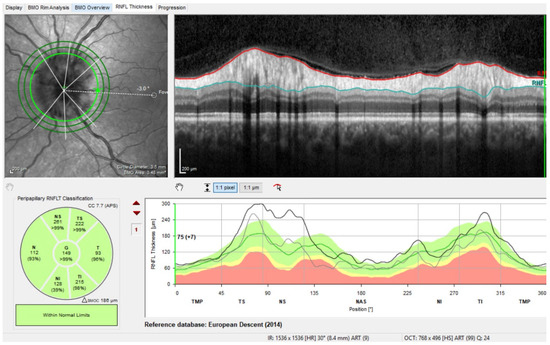 Current Status and Future Perspectives of Optic Nerve Imaging in Glaucoma