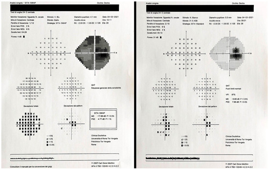 Short Wavelength Automated Perimetry, Standard Automated Perimetry, and ...