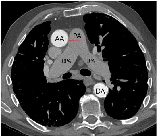 Radiological Parameters for the Detection of Pulmonary Hypertension in ...