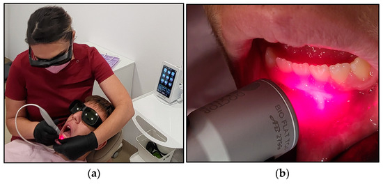 A Novel Therapeutic Approach of 980 nm Photobiomodulation Delivered with Flattop Beam Profile in ...