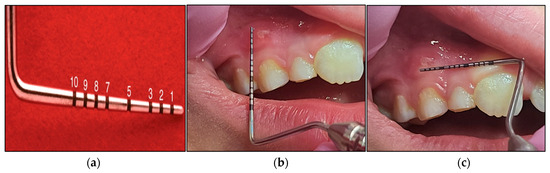 A Novel Therapeutic Approach of 980 nm Photobiomodulation Delivered with Flattop Beam Profile in ...