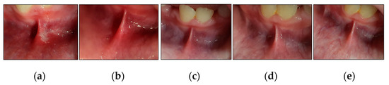 A Novel Therapeutic Approach of 980 nm Photobiomodulation Delivered with Flattop Beam Profile in ...