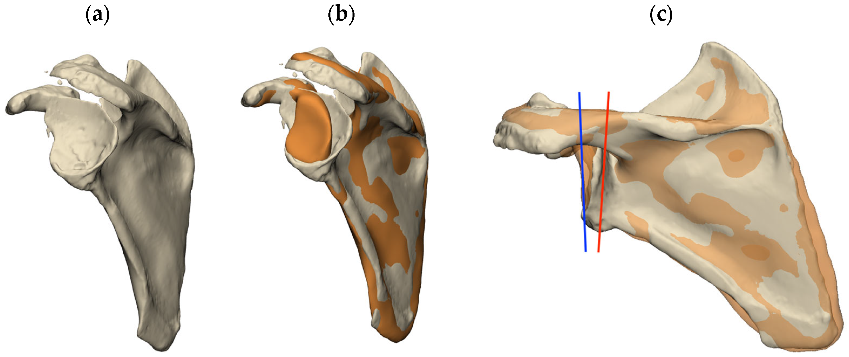 The Use of Glenoid Structural Allografts for Glenoid Bone Defects in ...