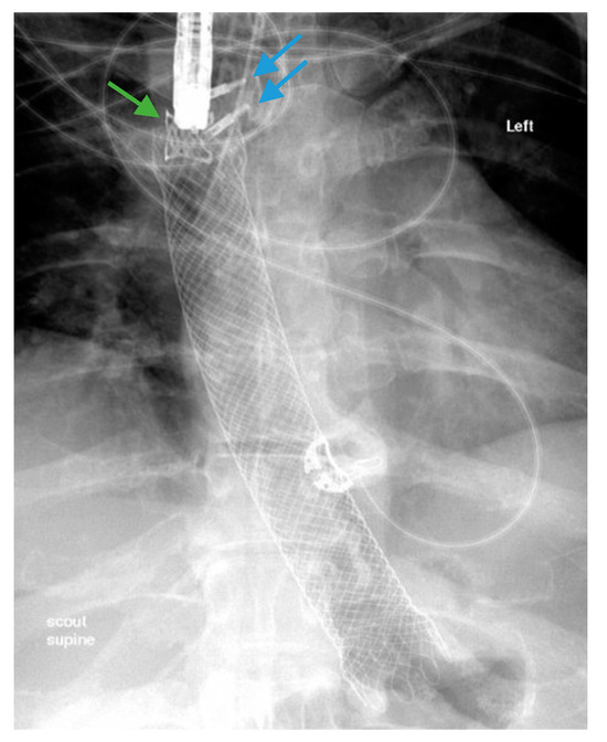 Endoscopic Management of Post-Sleeve Gastrectomy Complications