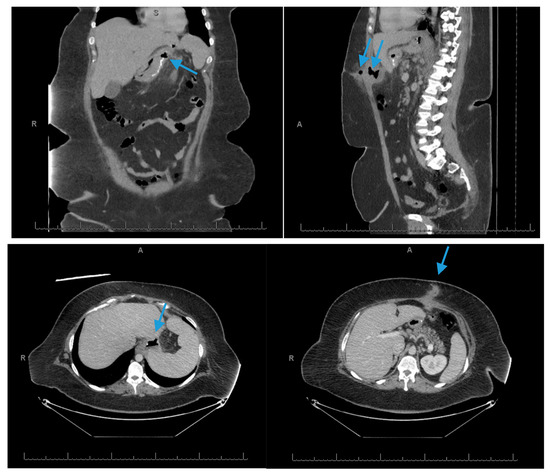 Endoscopic Management of Post-Sleeve Gastrectomy Complications