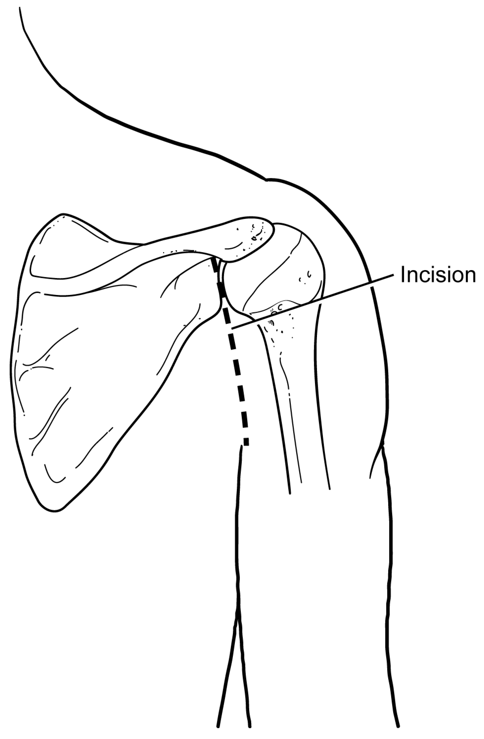 Posterior Shoulder Instability and Glenoid Bone Loss: A Review and a ...