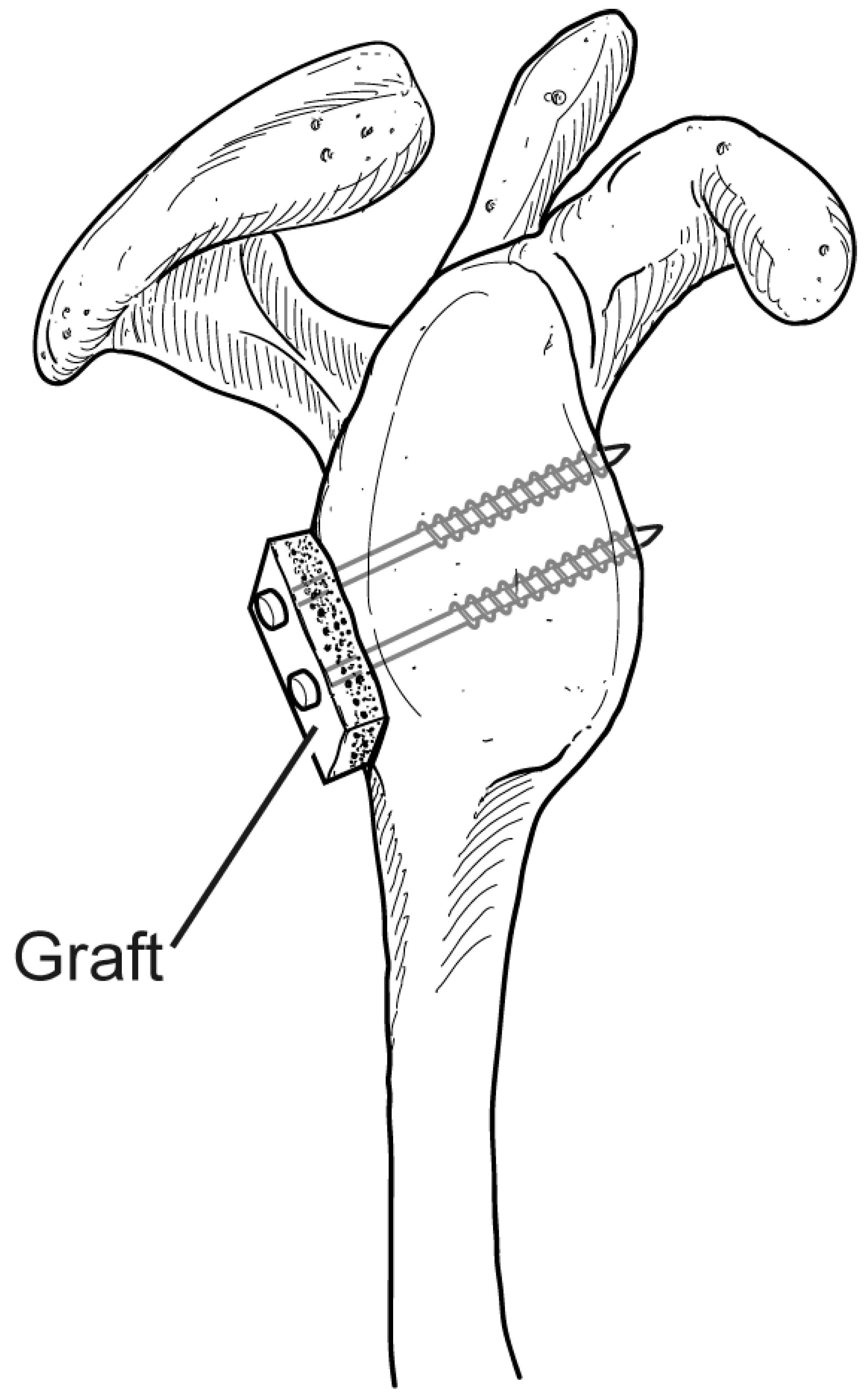 JCM | Free Full-Text | Posterior Shoulder Instability and Glenoid Bone ...