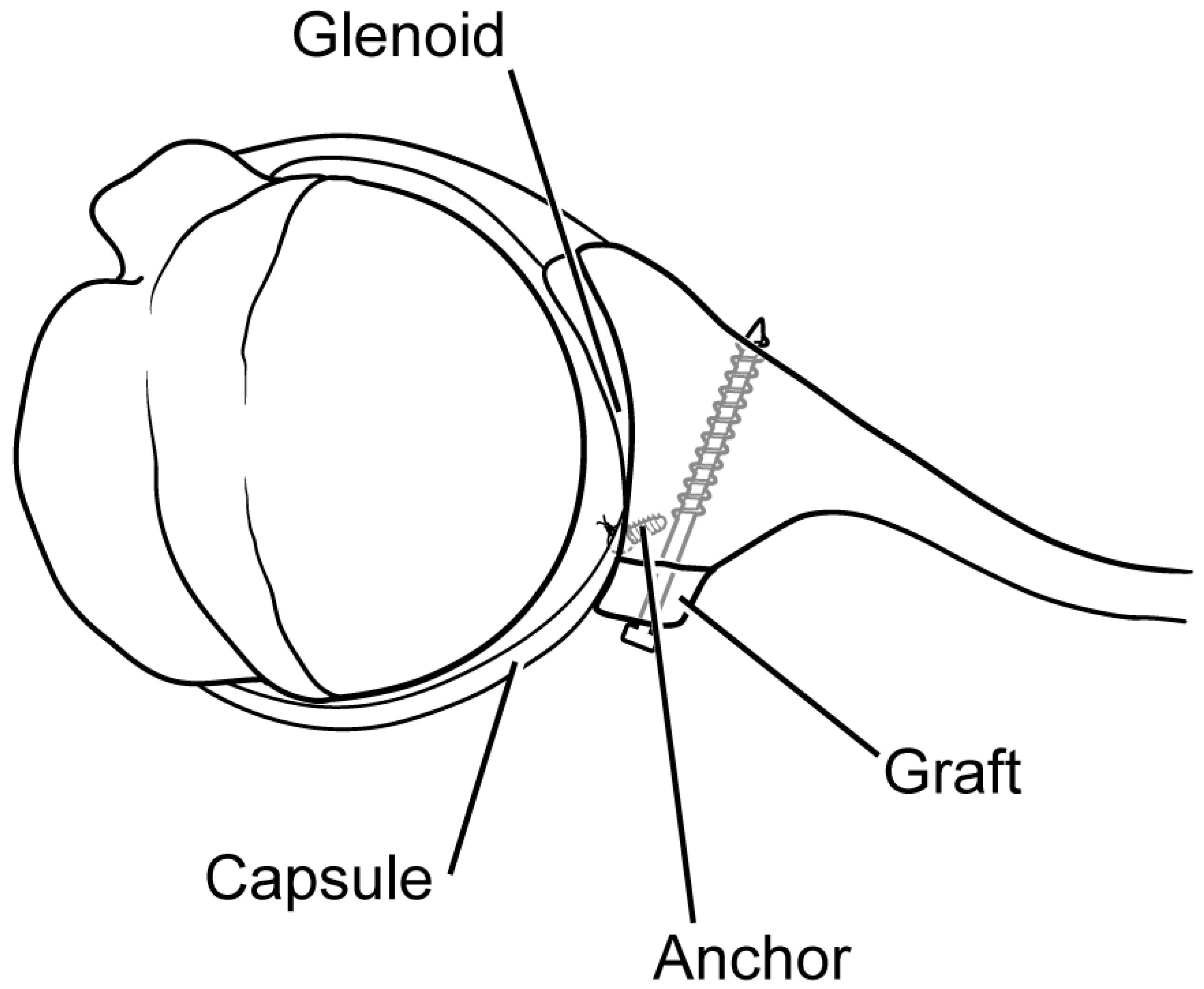 Posterior Shoulder Instability and Glenoid Bone Loss: A Review and a ...