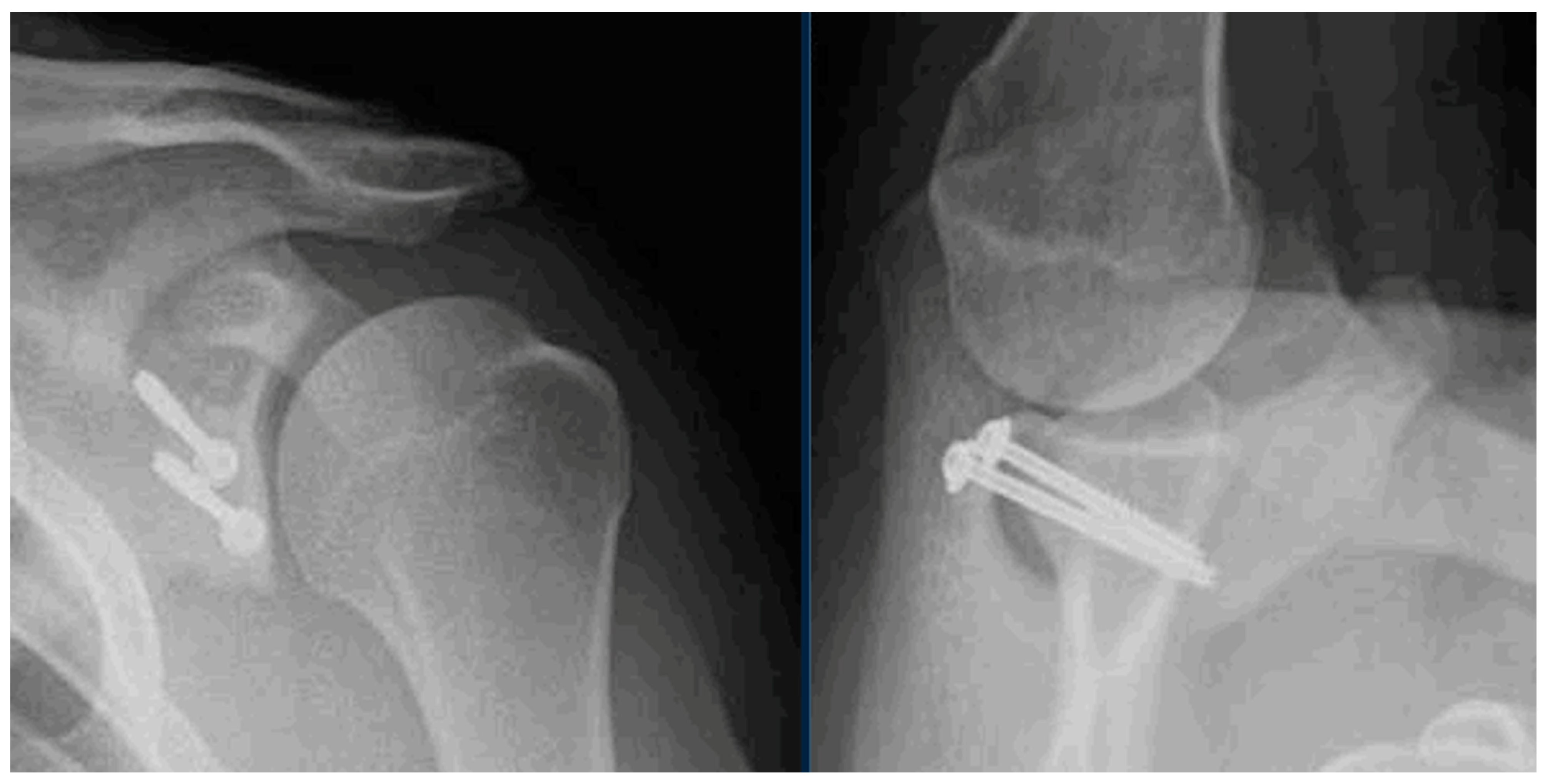 Posterior Shoulder Instability and Glenoid Bone Loss: A Review and a ...