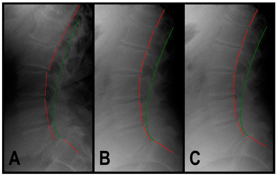 JCM | Free Full-Text | Improvement in Pain, Quality of Life, and ...