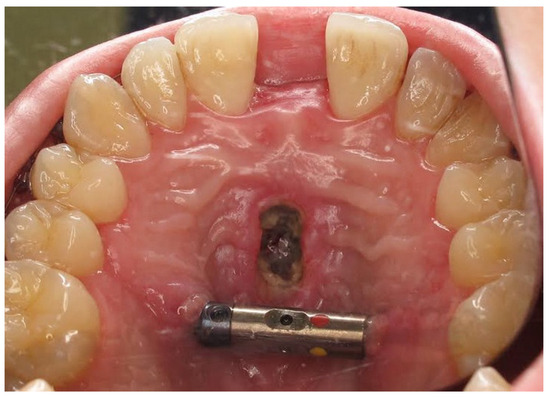 Complications of Surgically Assisted Rapid Maxillary/Palatal Expansion ...