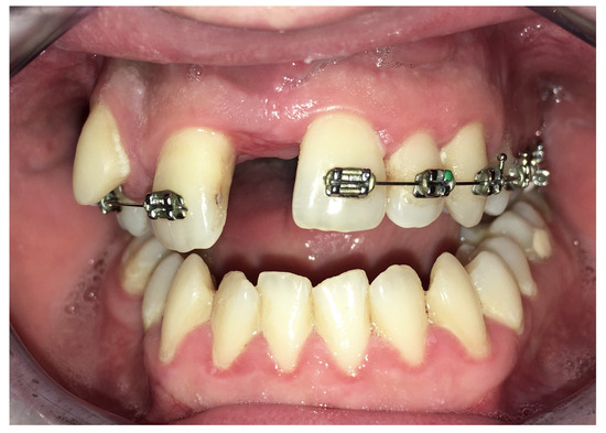Complications of Surgically Assisted Rapid Maxillary/Palatal Expansion ...