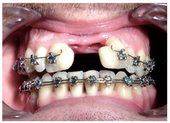Complications of Surgically Assisted Rapid Maxillary/Palatal Expansion ...
