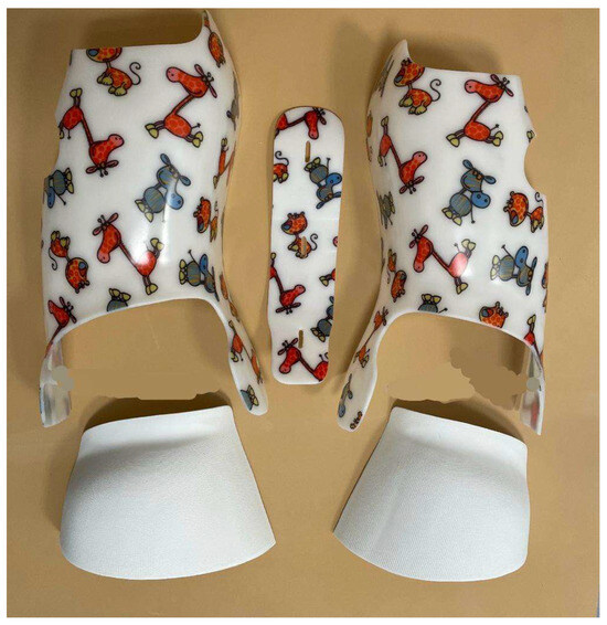 The New Modular Sforzesco Brace (Modular Italian Brace) Is as Effective ...