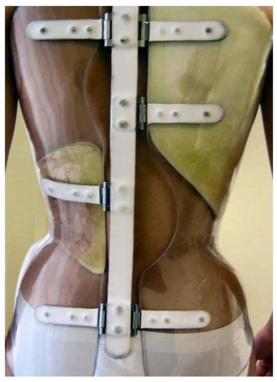 The New Modular Sforzesco Brace (Modular Italian Brace) Is as Effective ...