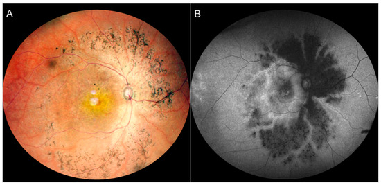Retinal Imaging Findings in Inherited Retinal Diseases