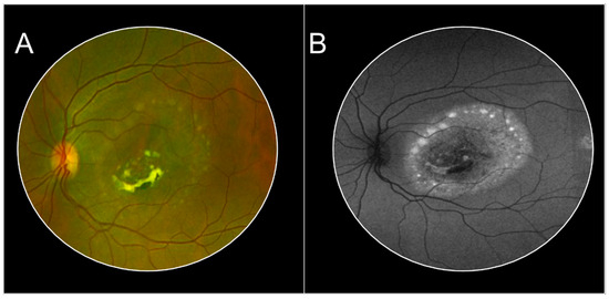 Retinal Imaging Findings in Inherited Retinal Diseases