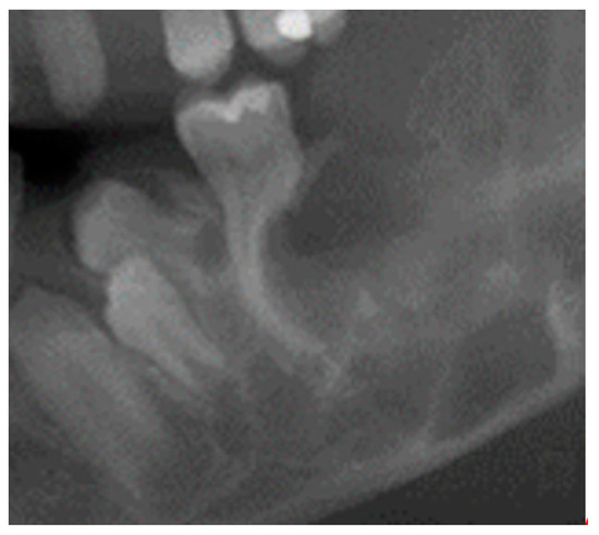 Thoughts on the Etiology of Cherubism