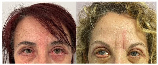 Persistent Conjunctival Chemosis after Lower Lid Blepharoplasty: A ...