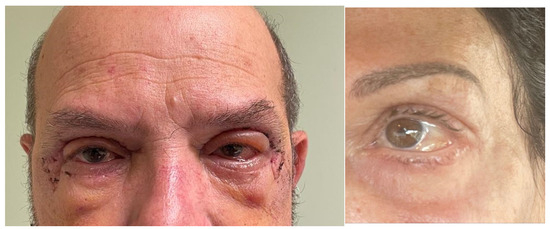 Persistent Conjunctival Chemosis after Lower Lid Blepharoplasty: A ...