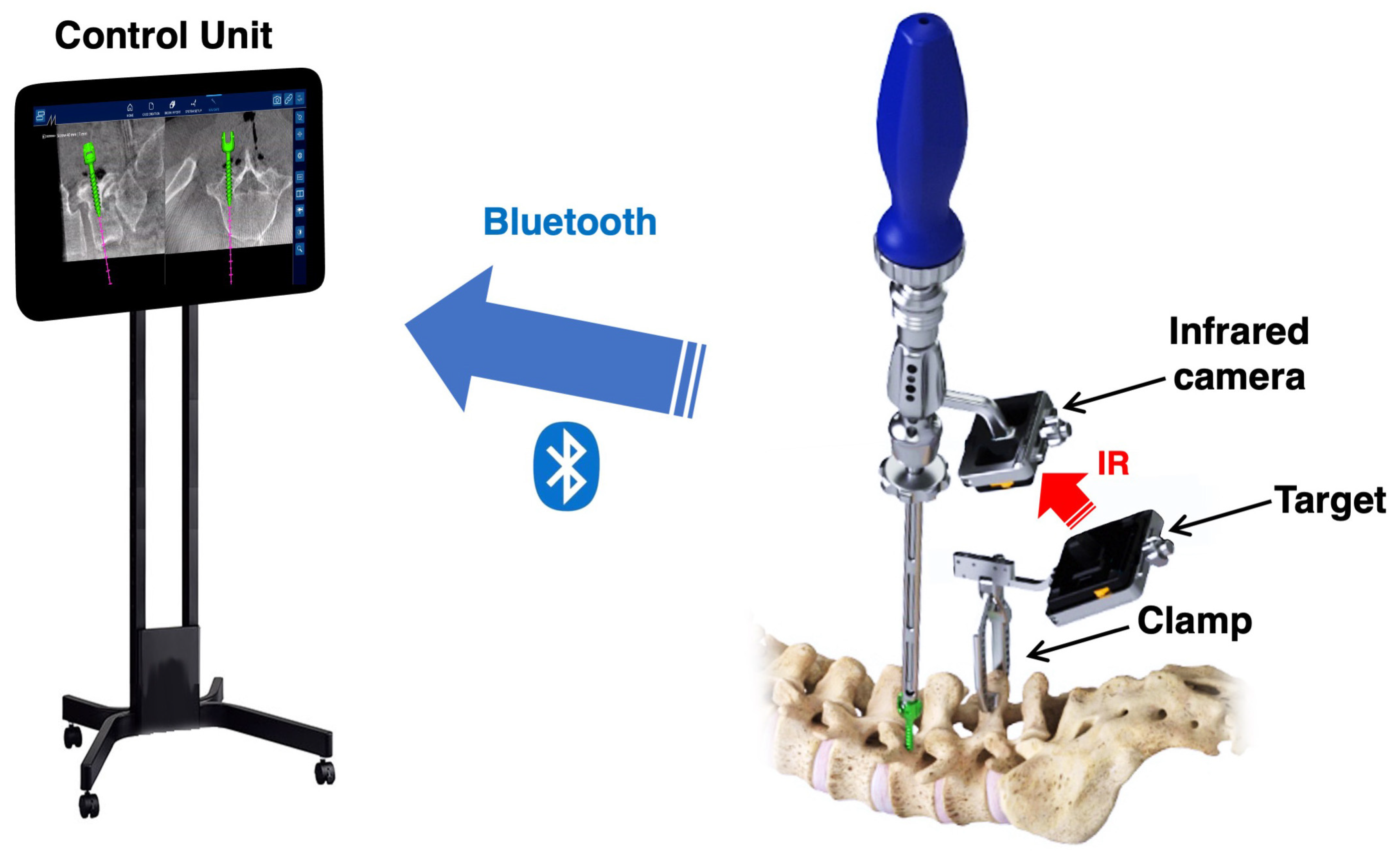 Jcm Free Full Text A Novel Intraoperative Ct Navigation System For