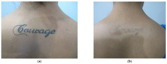 Advancements in Laser Therapies for Dermal Hyperpigmentation in Skin of ...