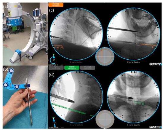Evolution of Cervical Endoscopic Spine Surgery: Current Progress and ...