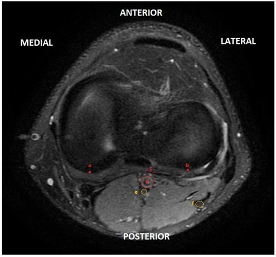 Anatomical Safety Area for Periarticular Analgesic Infiltration through ...