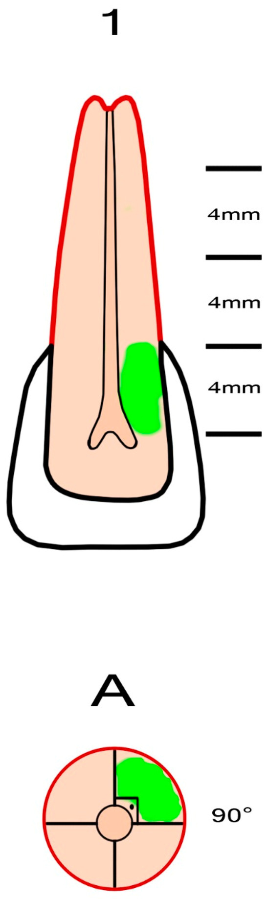 An Evaluation of the Fracture Resistance of Teeth with Simulated ...