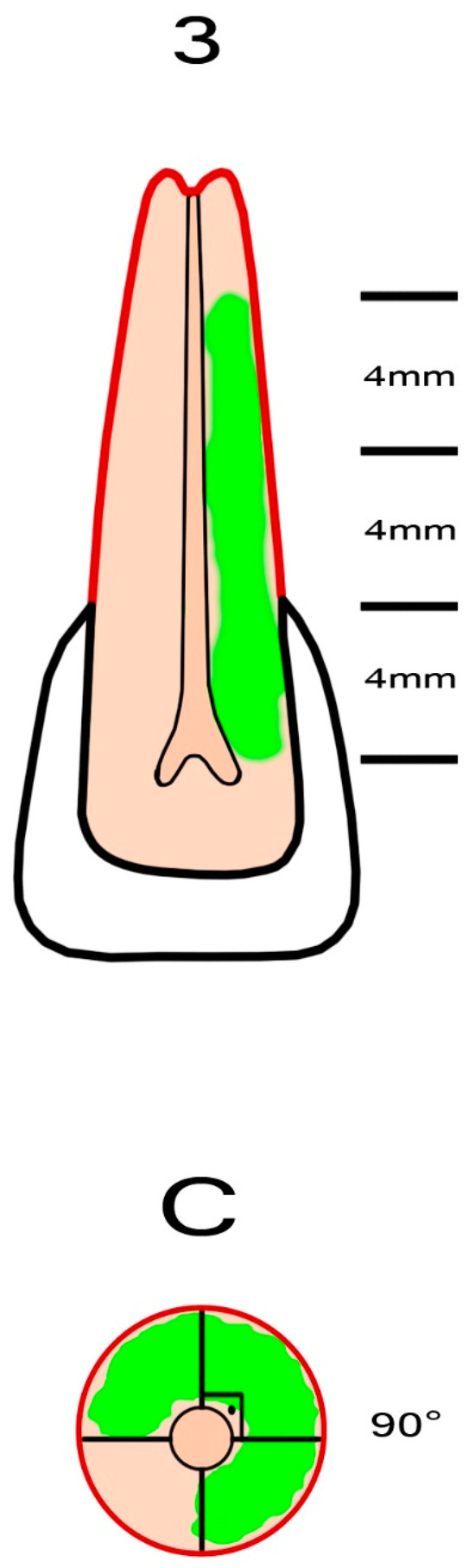 An Evaluation of the Fracture Resistance of Teeth with Simulated ...