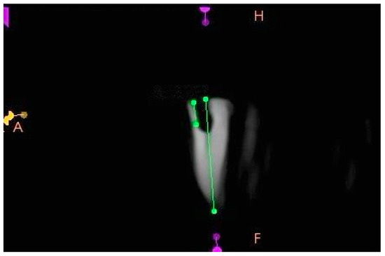 An Evaluation of the Fracture Resistance of Teeth with Simulated ...