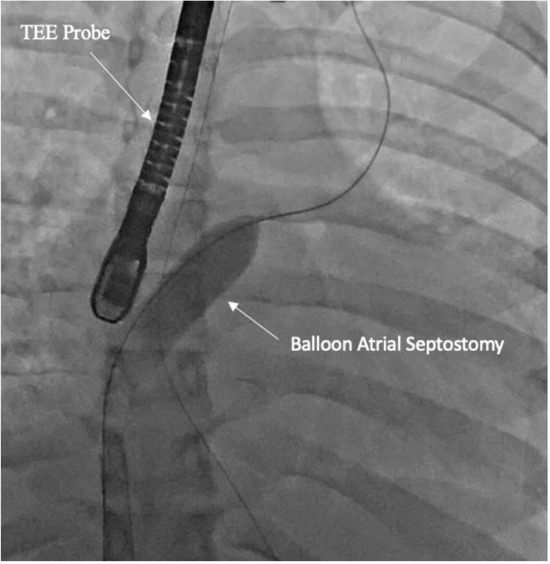 Lessons from the Pandemic: Role of Percutaneous ECMO and Balloon Atrial ...