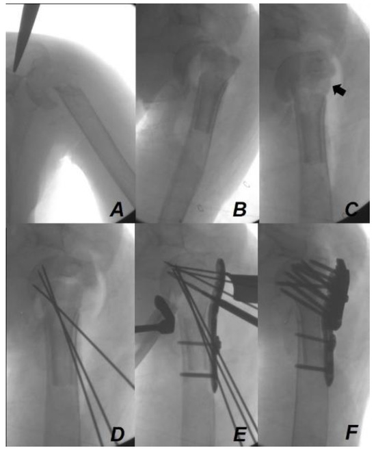 Novel Use of a Fibular Strut Allograft with Fibular Head in an Elderly ...