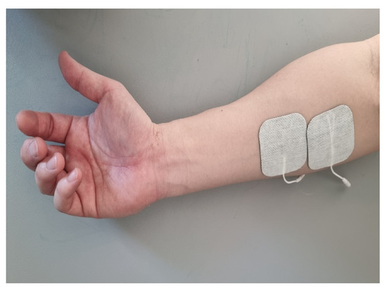 Effects of Transcutaneous Electrical Nerve Stimulation with Taping on ...