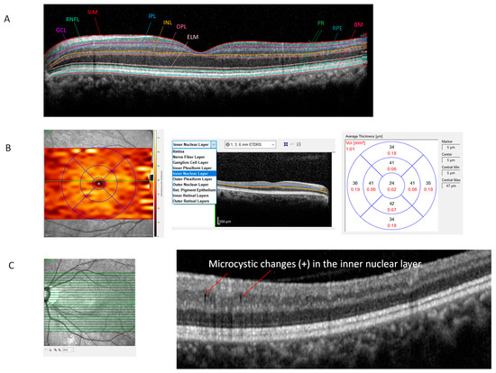 Thicker Inner Nuclear Layer as a Predictor of Glaucoma Progression and ...