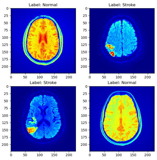 Automated Ischemic Stroke Classification from MRI Scans: Using a Vision Transformer Approach