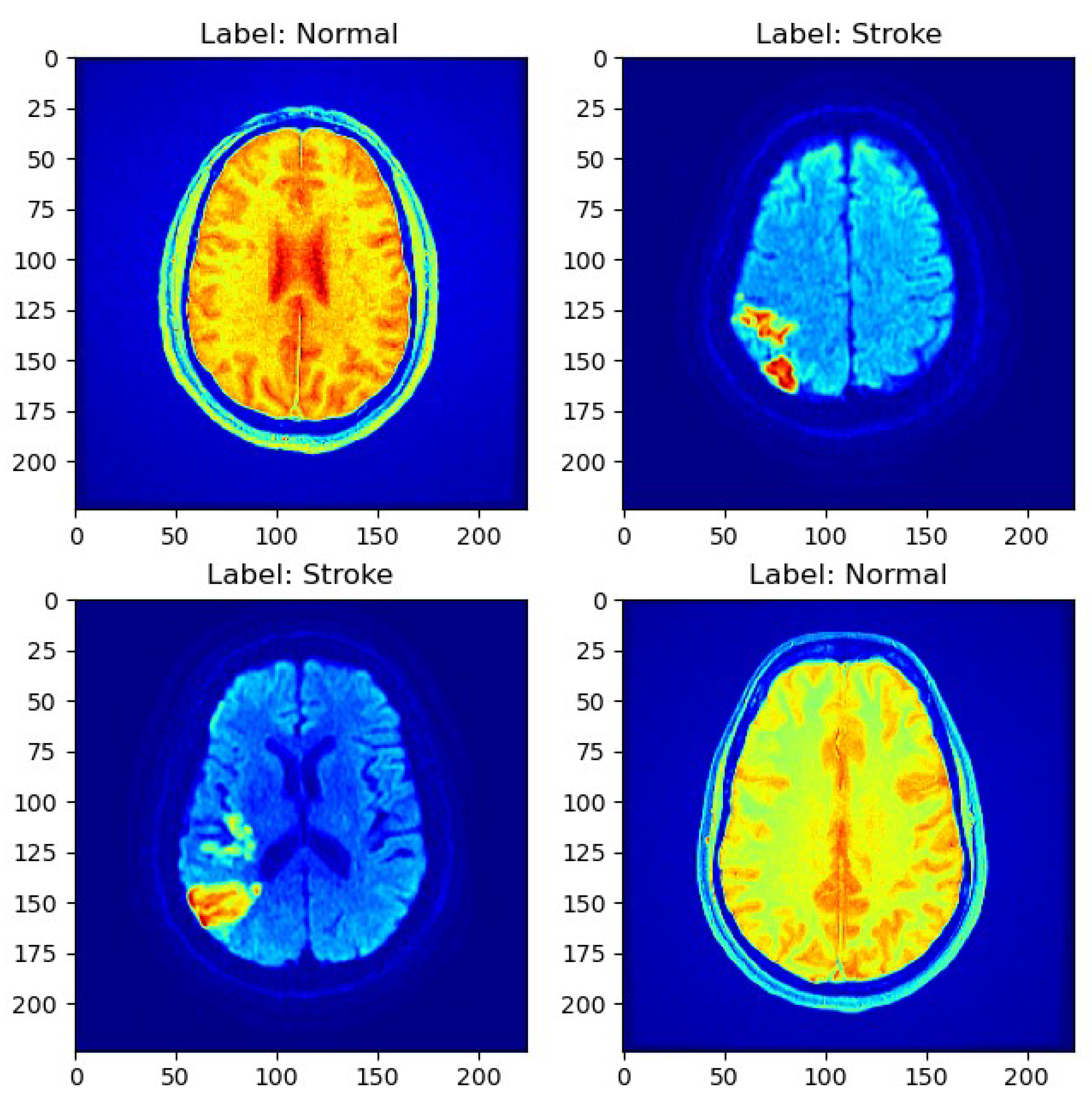 Automated Ischemic Stroke Classification from MRI Scans: Using a Vision Transformer Approach