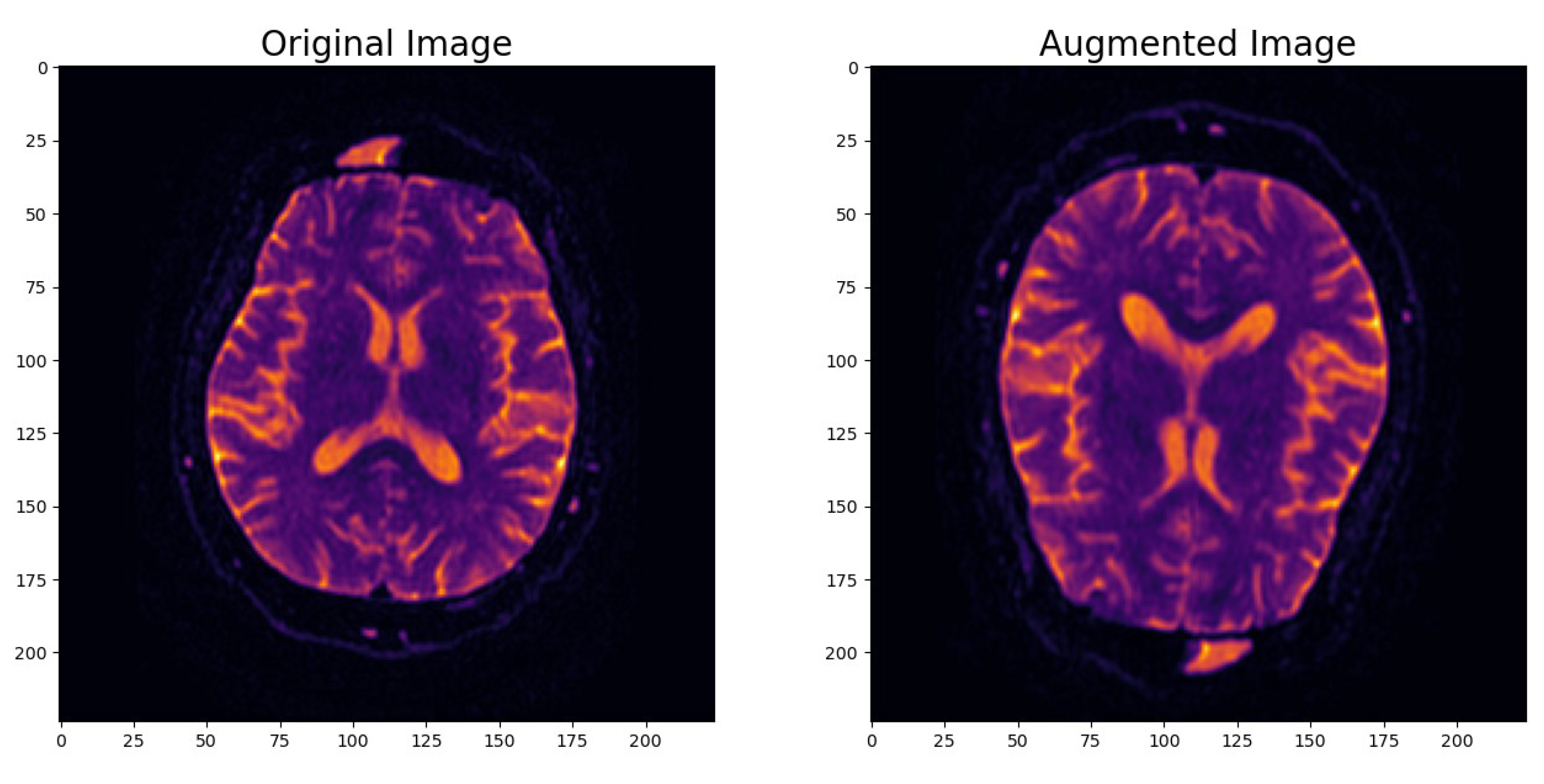 Automated Ischemic Stroke Classification from MRI Scans: Using a Vision Transformer Approach