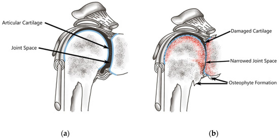 Glenohumeral Osteoarthritis: A Biological Advantage or a Missed Diagnosis?