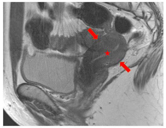 MRI-Based Radiomics as a Promising Noninvasive Diagnostic Technique for ...