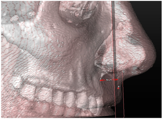 Novel Parameter in Pre-Surgical Orthodontic Preparation: A ...