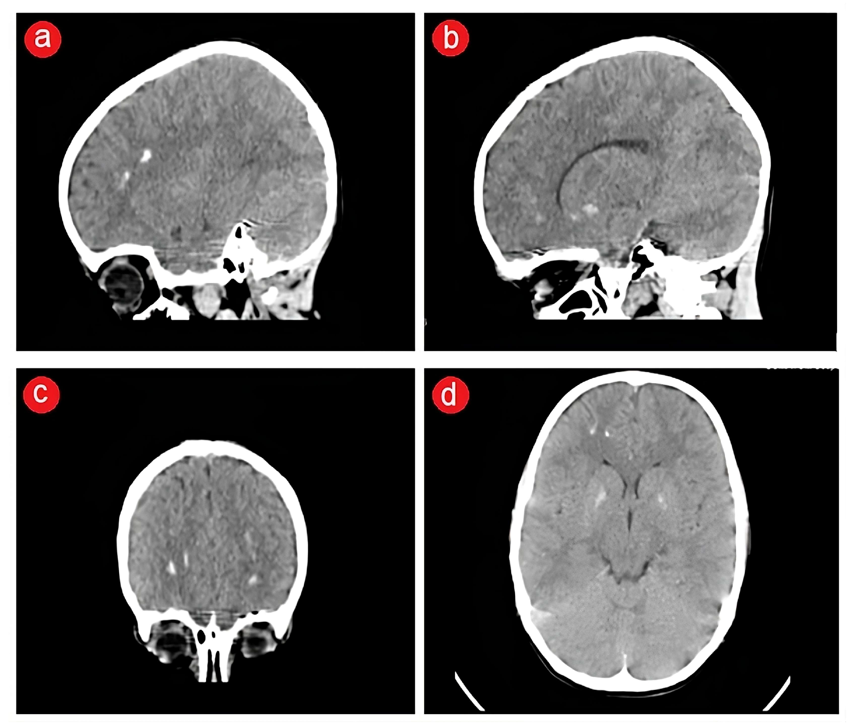 Exploring Chronic Hypocalcemia: Insights into Autoimmune Polyglandular ...