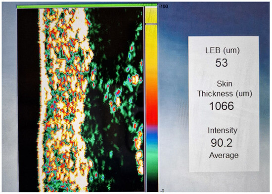 The Use of Fish Skin Grafts in Children as a New Treatment of Deep ...