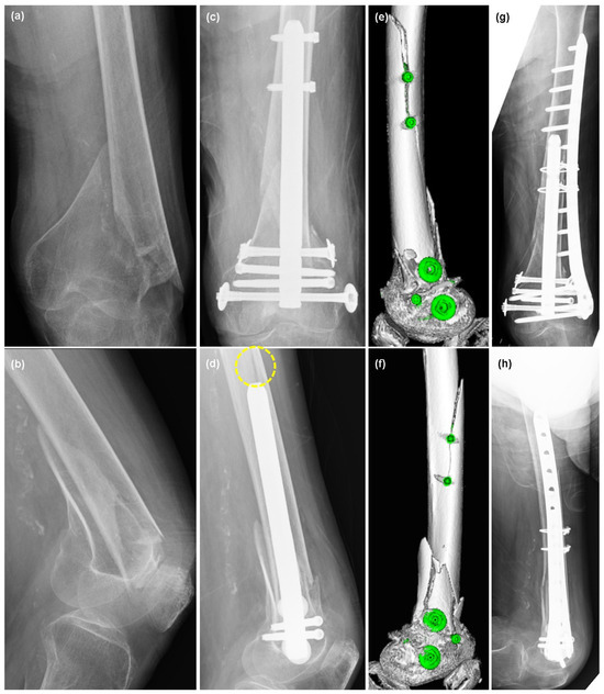 Intraoperative Fracture during the Insertion of Advanced Locking Screws (T2 Alpha Femur ...