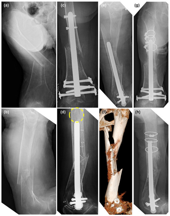 Intraoperative Fracture during the Insertion of Advanced Locking Screws ...