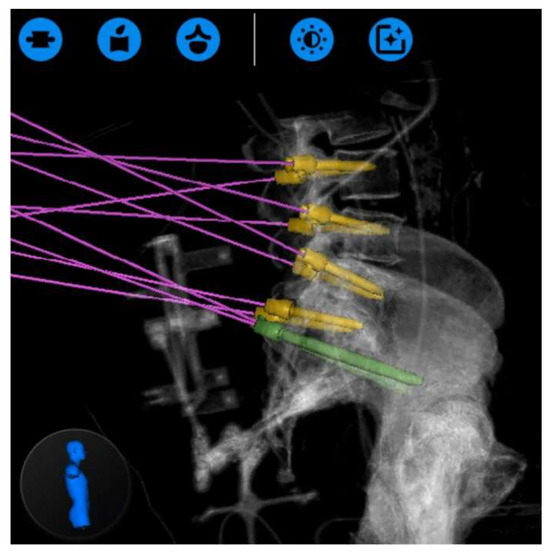 Pushing the Limits of Minimally Invasive Spine Surgery—From ...