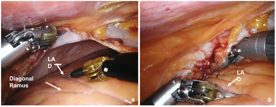Robotic-Assisted Minimally Invasive Direct Coronary Artery Bypass ...