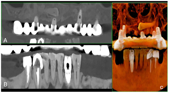 Potential Benefits of Photon-Counting CT in Dental Imaging: A Narrative ...