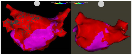 Vein of Marshall Ethanol Infusion for AF Ablation; A Review