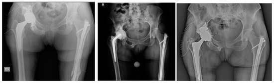 Revision of Failed Short Stems in Total Hip Arthroplasty